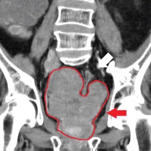 What I've Learned as a Prostate Cancer Surgeon ... and Survivor ...